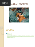 LSCS | PDF | Childbirth | Caesarean Section