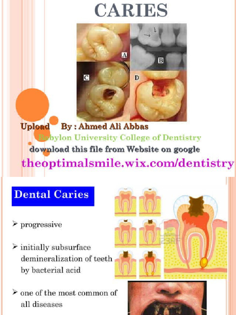 Dental Caries 41026065 | PDF