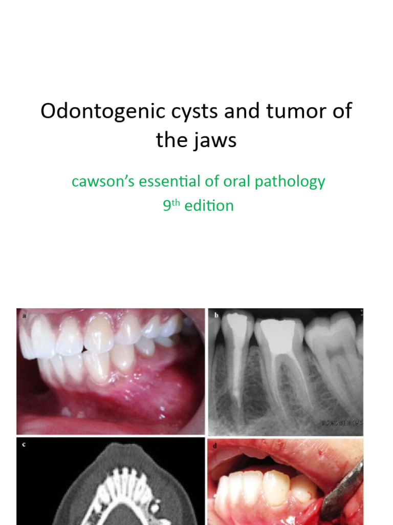 Odontogenic Cysts and Tumor of The Jaws | PDF | Diseases And Disorders ...