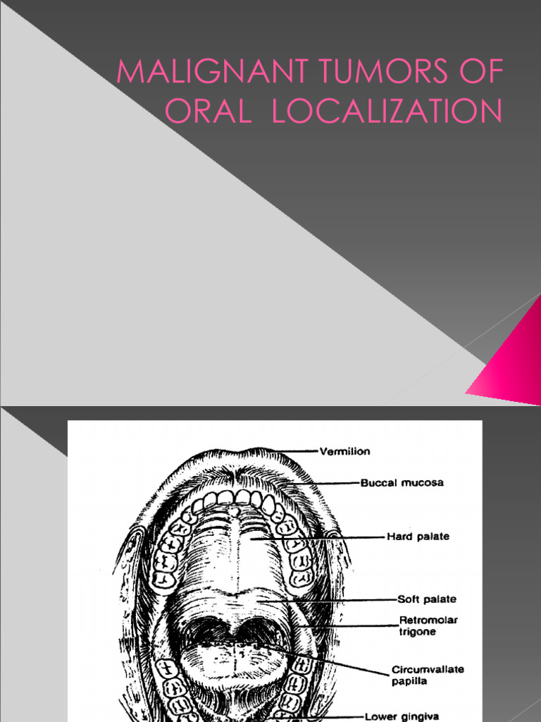 Oral Cancer: Types and Treatment Options | PDF | Carcinoma | Metastasis