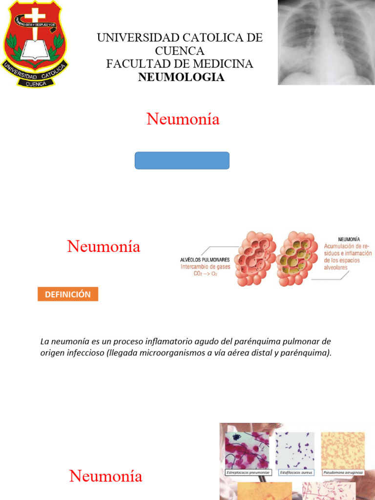 NEUMONÍA | PDF | Neumonía | Influenza