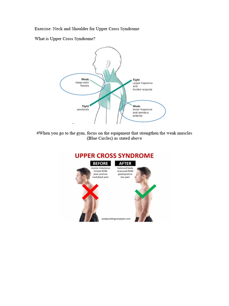 Upper Cross Syndrom Exe | PDF