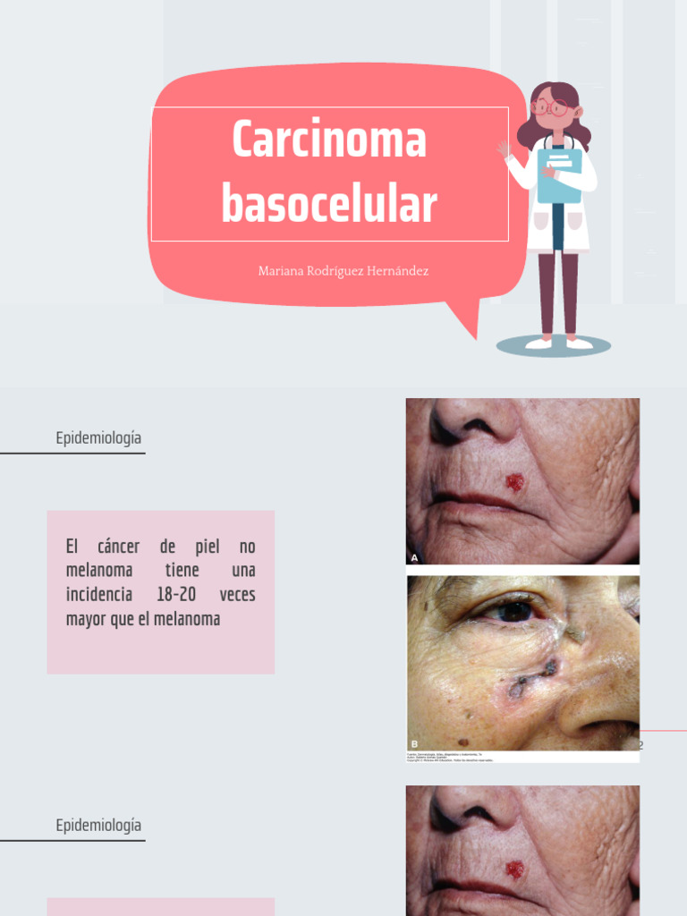 Carcinoma Basocelular | PDF | Cáncer | Melanoma