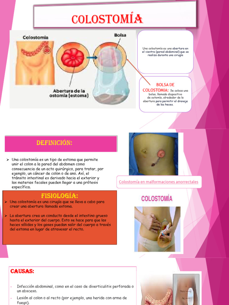 Guía de Cuidados para Colostomía | PDF | Cáncer colonrectal | Intestino ...