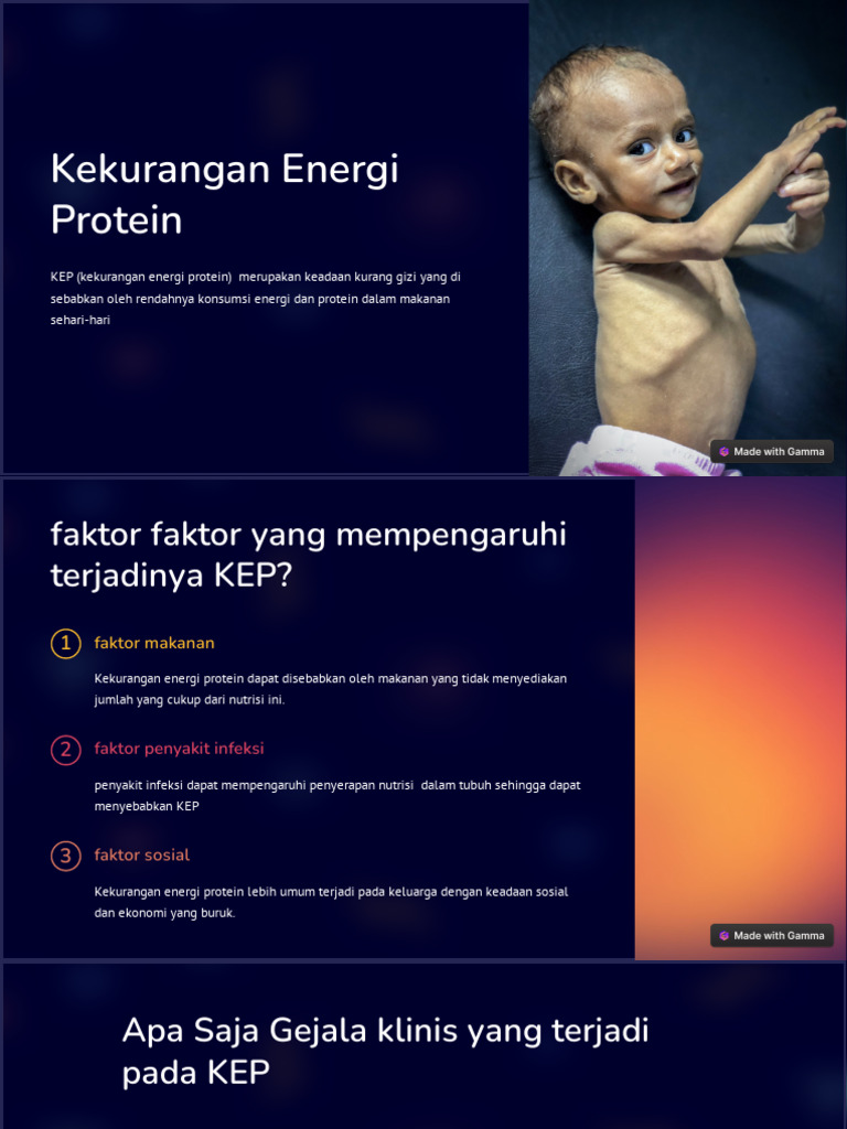 Kekurangan Energi Protein | PDF