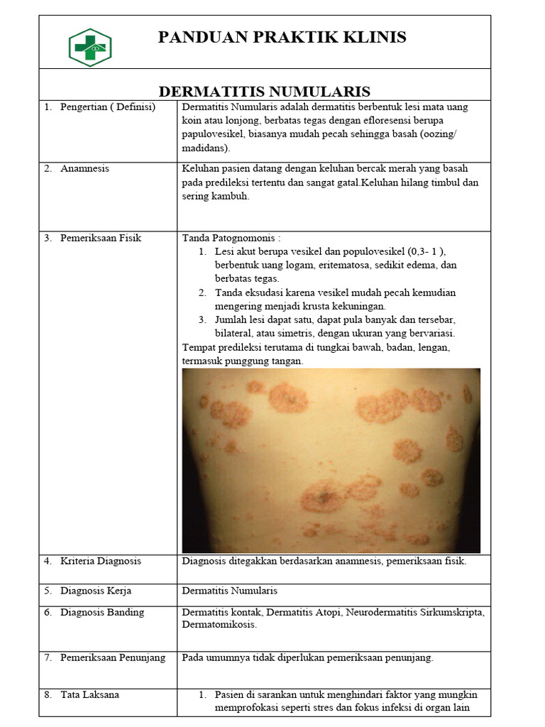 PPK Dermatitis Numularis 2019 | PDF