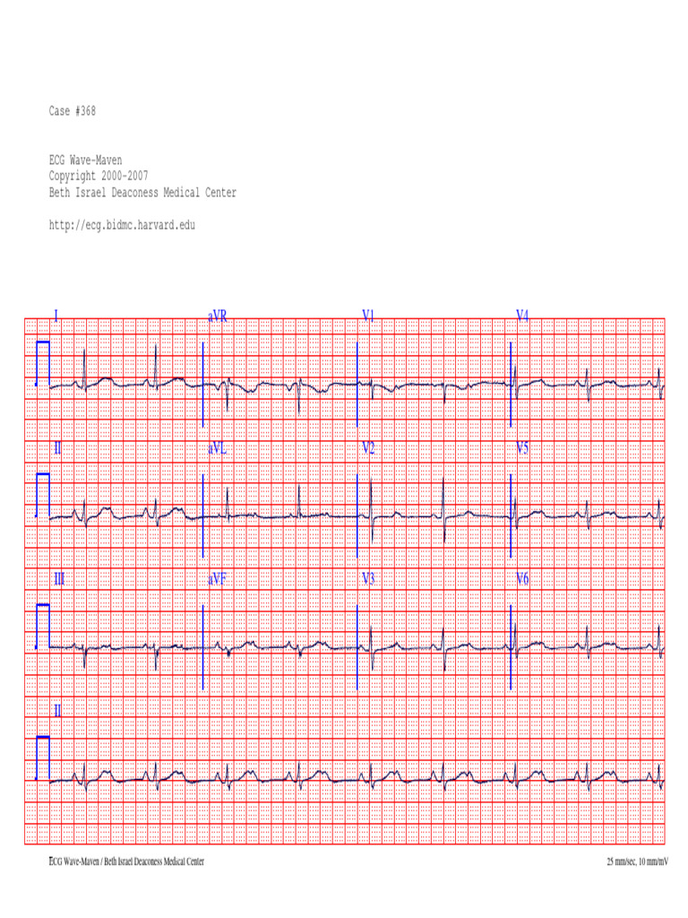 I aVR V1 V4: Case #368 ECG Wave-Maven Beth Israel Deaconess Medical ...
