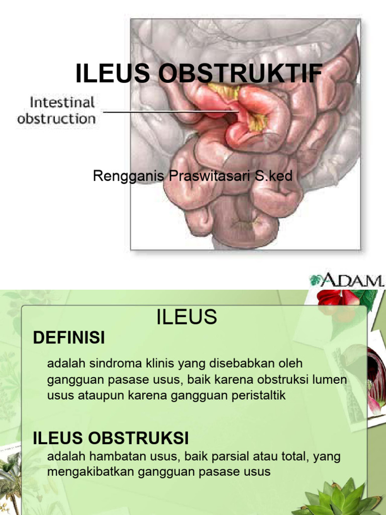 Ileus Obstruktif | PDF