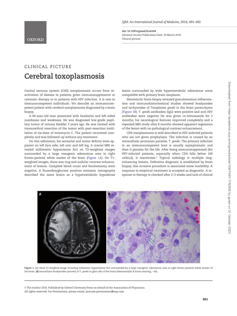 Cerebral Toxoplasmosis - 1 | PDF | Clinical Medicine | Medical Specialties