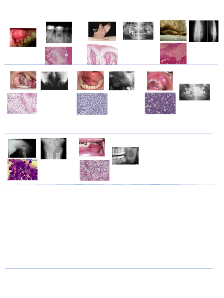 Malignant Non-Odontogenic Neoplasm | PDF