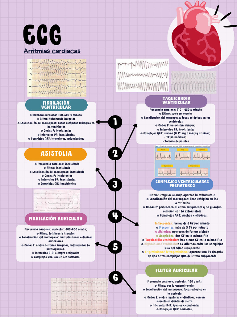 Arritmias Cardiacas: Asistolia | PDF | Electrocardiografia | Arritmia ...