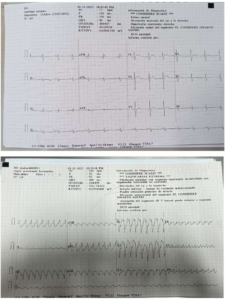 EKG | PDF