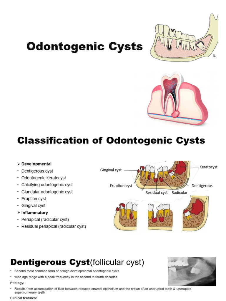 Odontogenic Cyst | PDF | Dental Anatomy | Dentistry Branches