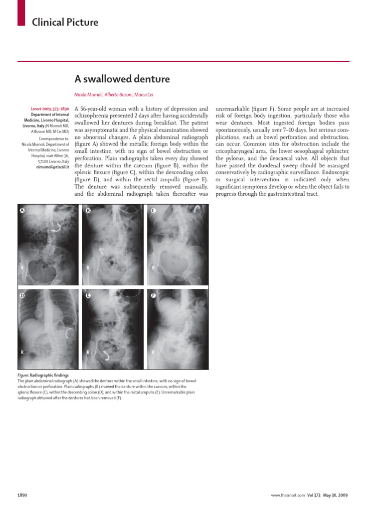 A Swallowed Denture Lancet | PDF