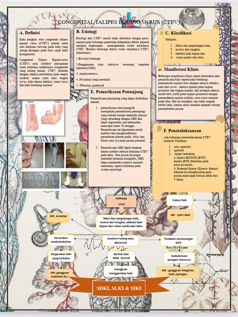 Congenital Talipes Equino Varus | PDF