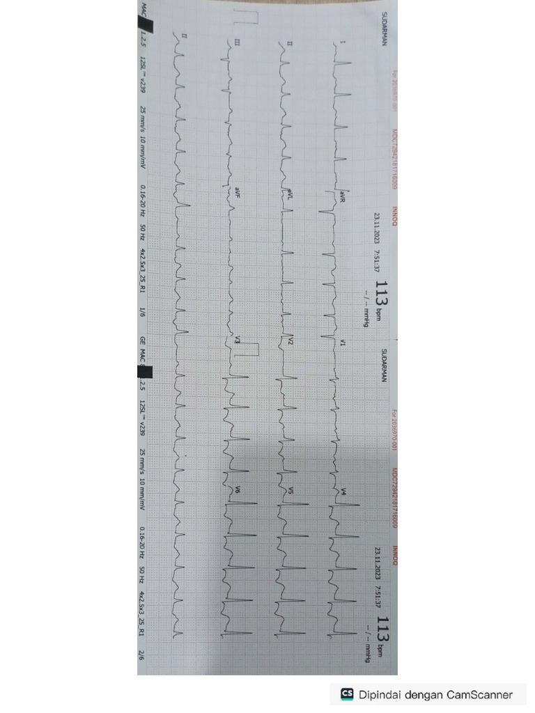 Ekg | PDF