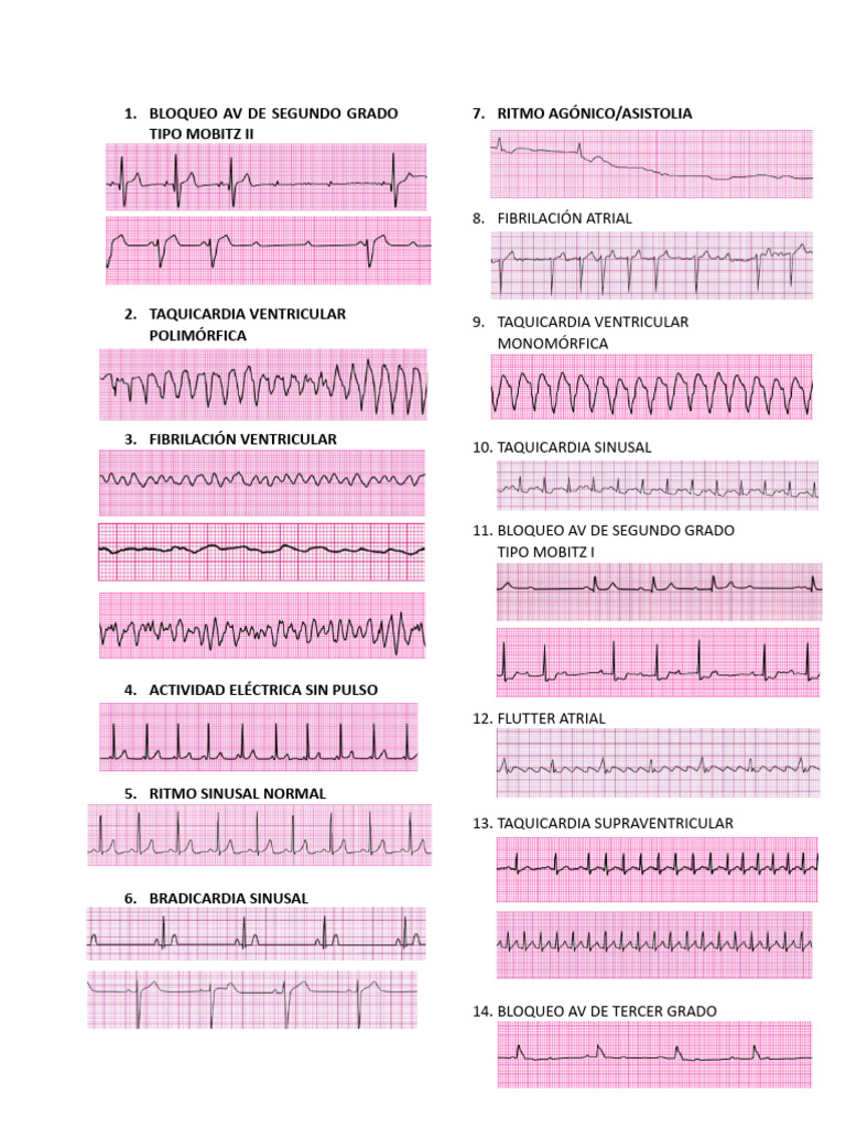 Ritmos Ecg Acls | PDF Ritmos Ecg Acls | PDF