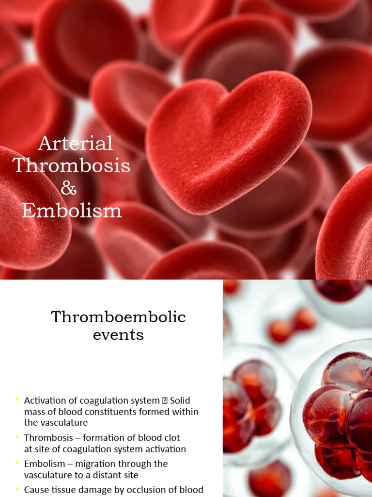 Arterial Thrombosis and Embolism | PDF | Thrombosis | Coagulation