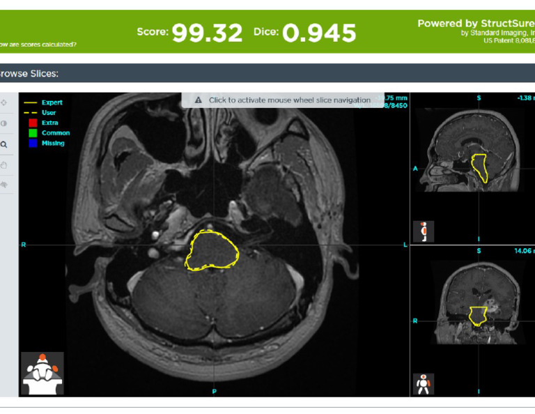 Brainstem Contour PDF | PDF