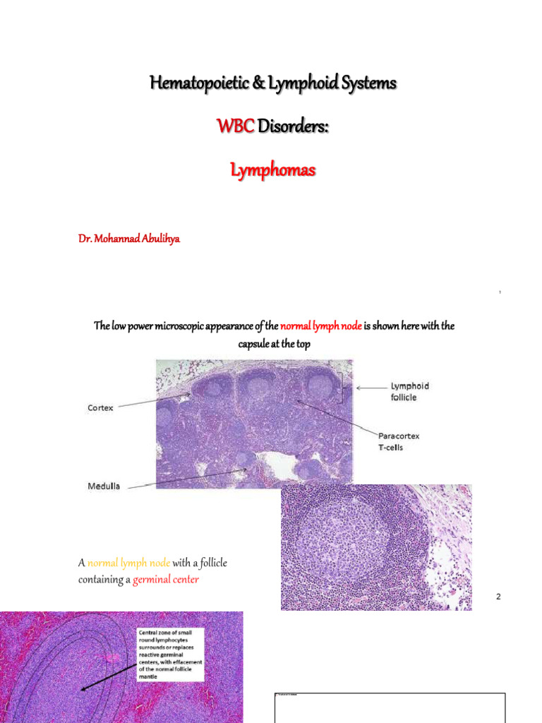 Lymphomas | PDF | Lymphoma | Lymphatic System