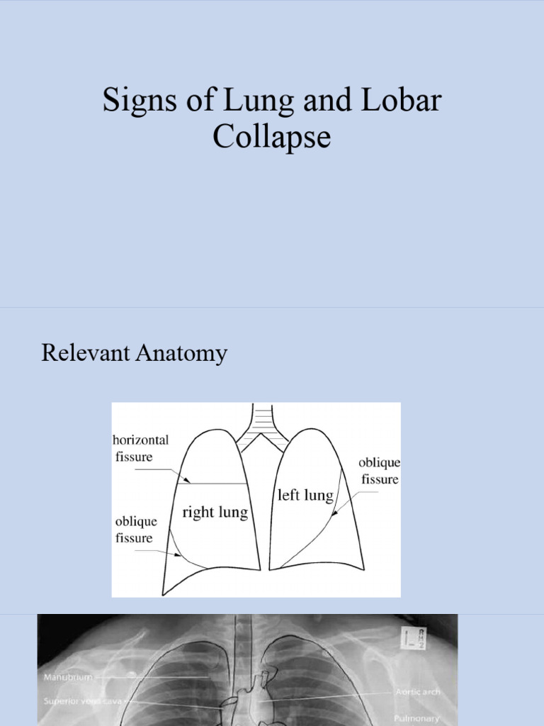 Signs of Lung and Lobar Collapse | PDF