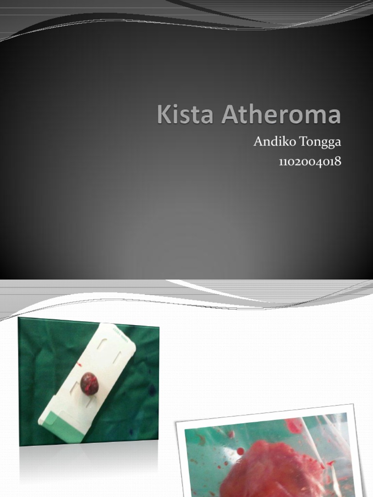 Laporan Medis Kista Ateroma | PDF