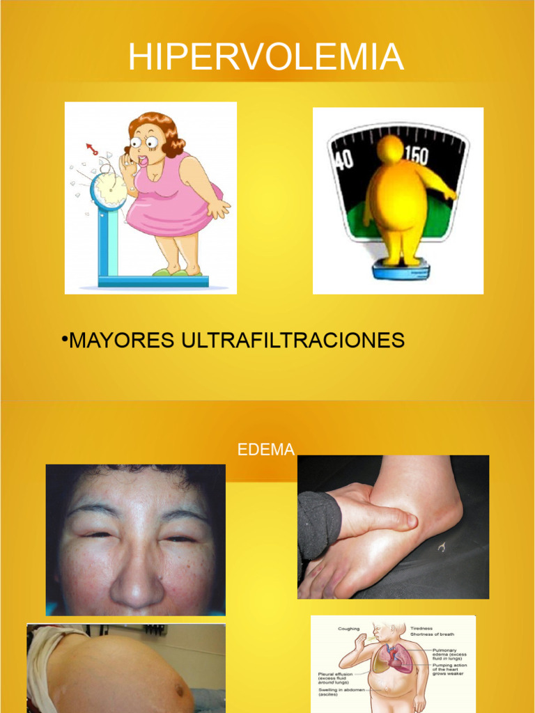 Hipervolemia | PDF | Hemodiálisis | Medicina CLINICA