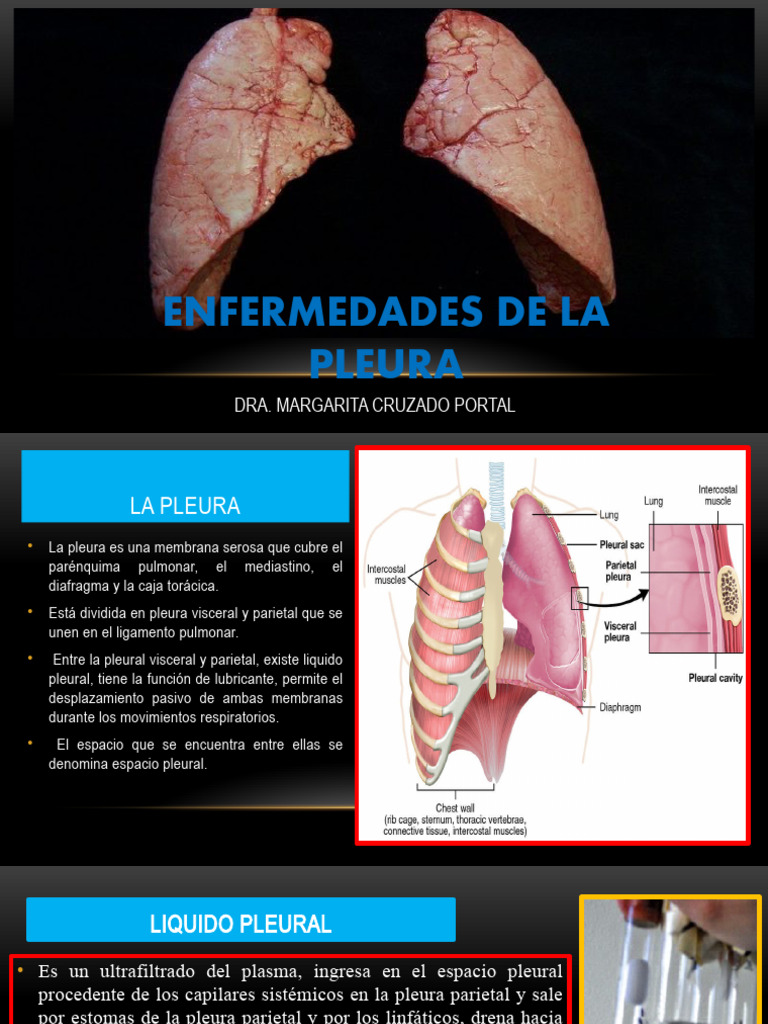 Enfermedades y Tratamientos de la Pleura | PDF | Especialidades Medicas ...