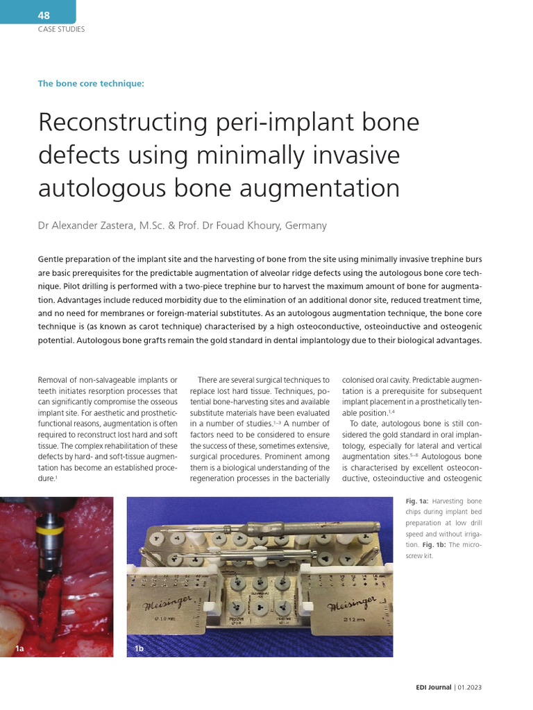 The Bone Core Technique Reconstructing Peri Implant Bone Defects Using ...
