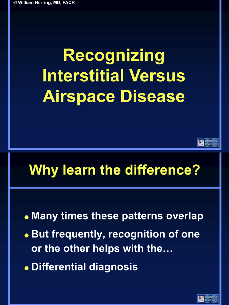 Interstitial Vs Airspace Disease | PDF