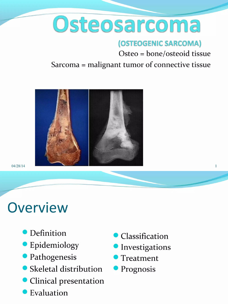 osteosarcoma-ppt-ppt | PDF
