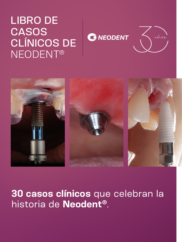 101432 Neodent 30years Clinicalcase Es Xx B00 in 200923 | PDF ...