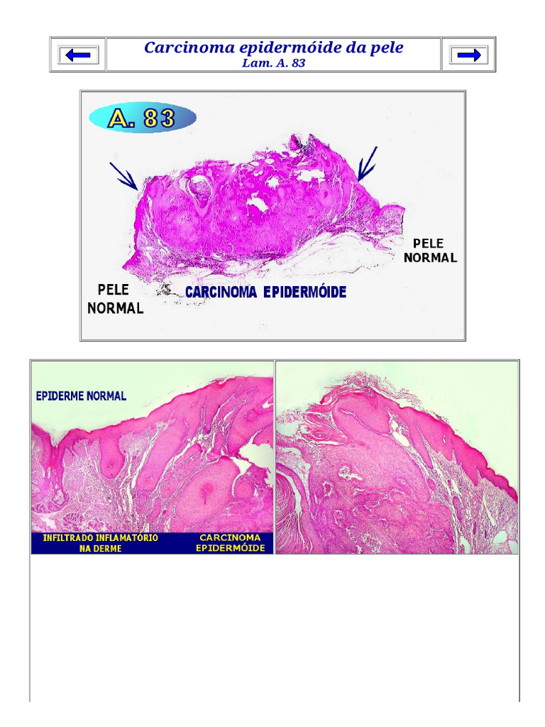 Carcinoma Epidermóide Da Pele - UNICAMP | PDF | Neoplasmas | Remédio