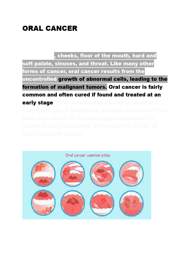 Oral Cancer01 | PDF | Cancer | Radiation Therapy