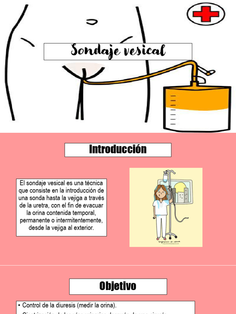 Sondaje Vesical: Procedimientos y Tipos | PDF | Salud y bienestar ...