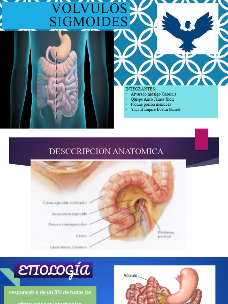 Volvulo Sigmoides: Anatomía y Tratamiento | PDF | Especialidades ...
