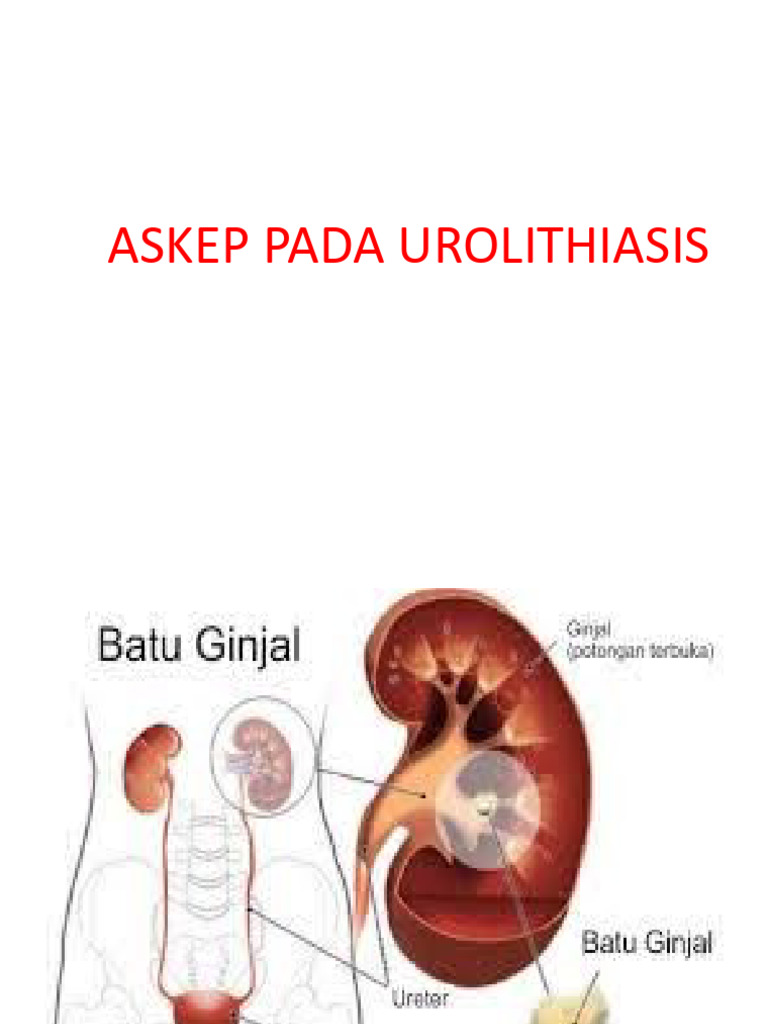Askep Urolithiasis | PDF