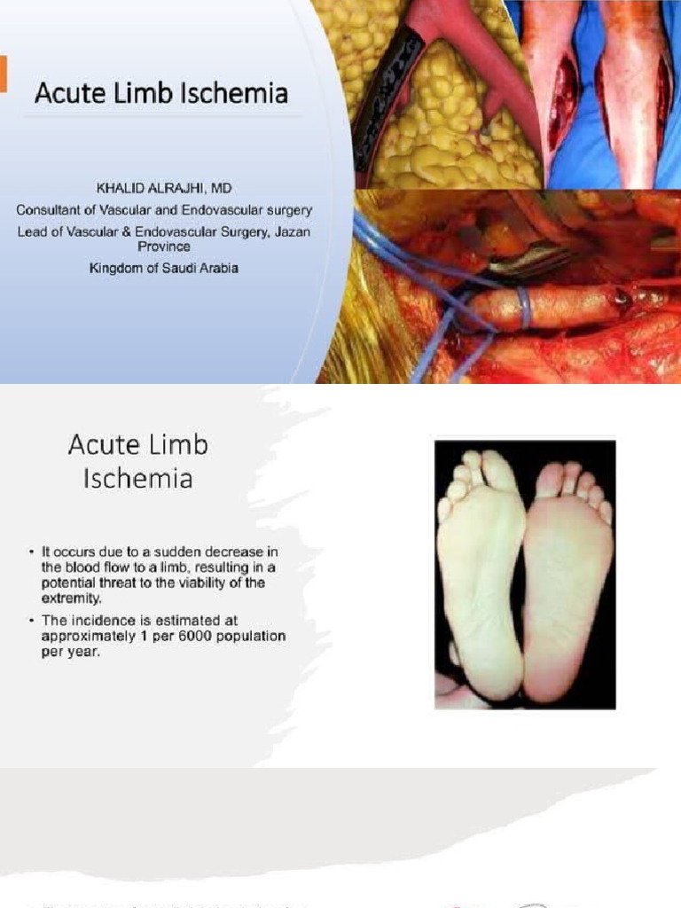 Acute Limb Ischemic | PDF