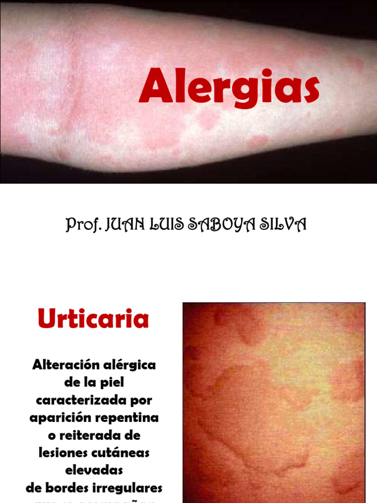 Alergias. Urticaria | PDF
