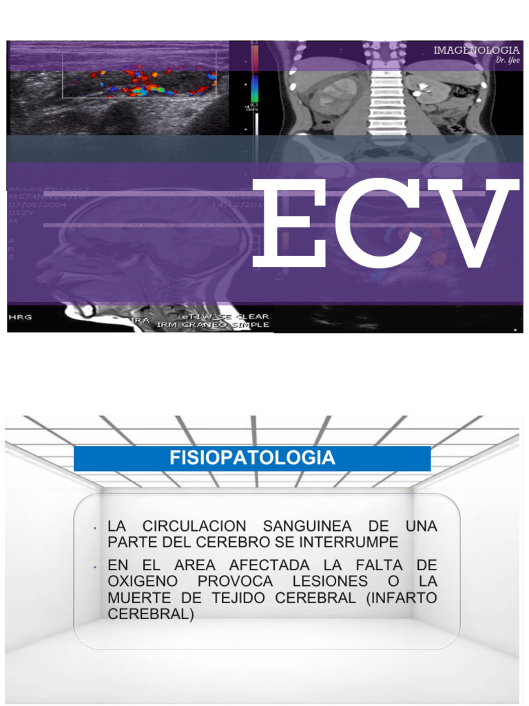Tomografía Cerebral en ECV y Aneurismas | PDF | Isquemia | Imagenes medicas