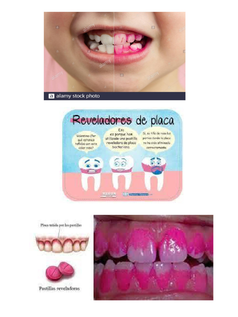 Placa Bacteriana | PDF