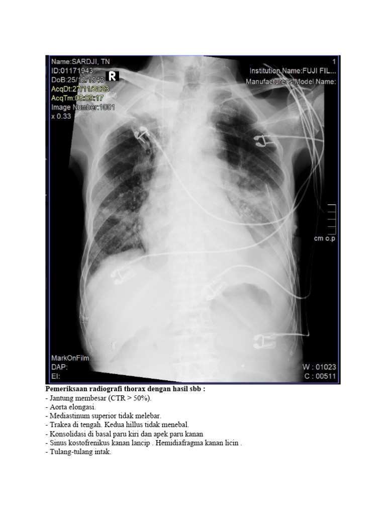 Pemeriksaan Radiografi Thorax Dengan Hasil SBB | PDF