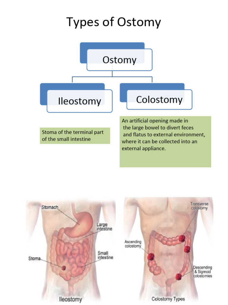 Types and Management of Ostomy | PDF | Clinical Medicine | Gastroenterology