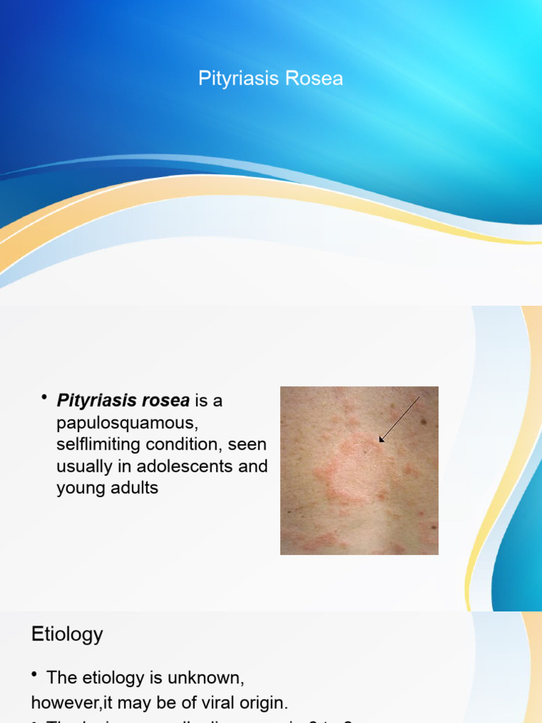 Pityriasis Rosea | PDF