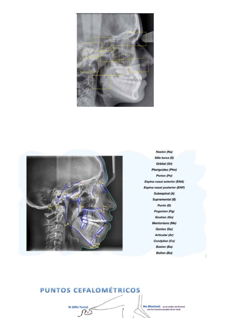 Análisis de Rickets en la Fosa Pterigomaxilar | PDF