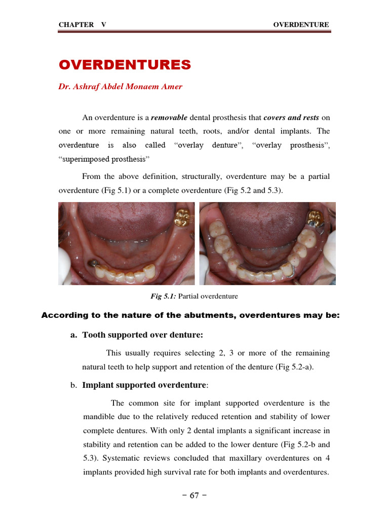 6 - Overdenture Book | PDF