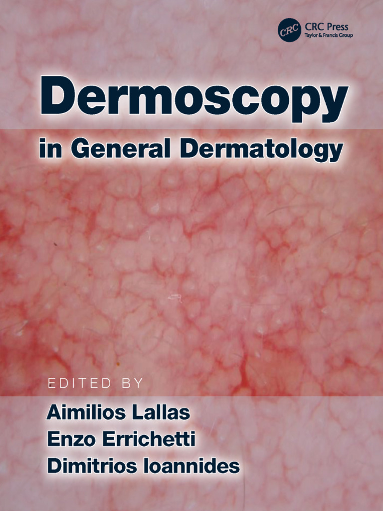 Ebook - Dermoscopy in General Dermatology | PDF