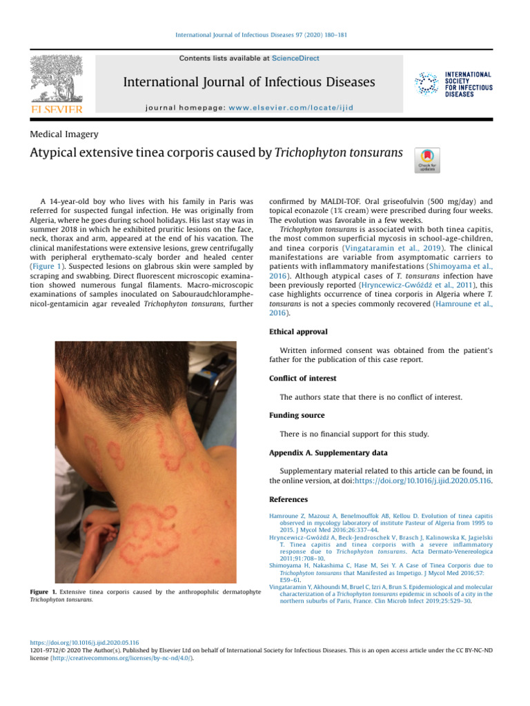 Atypical Extensive Tinea Corporis Caused B - 2020 - International ...