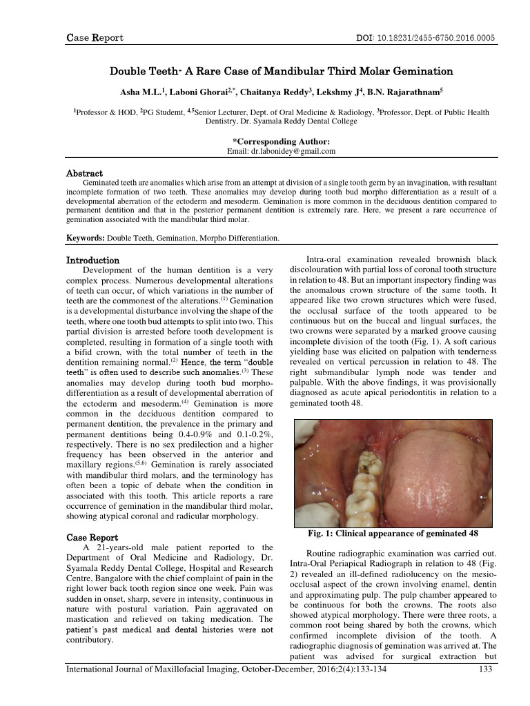 Double Teeth-A Rare Case of Mandibular Third Molar Gemination | PDF ...