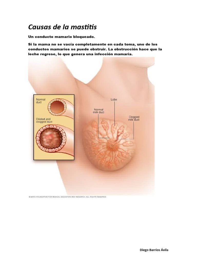 Causas de Mastitis | PDF | Amamantamiento | Pecho